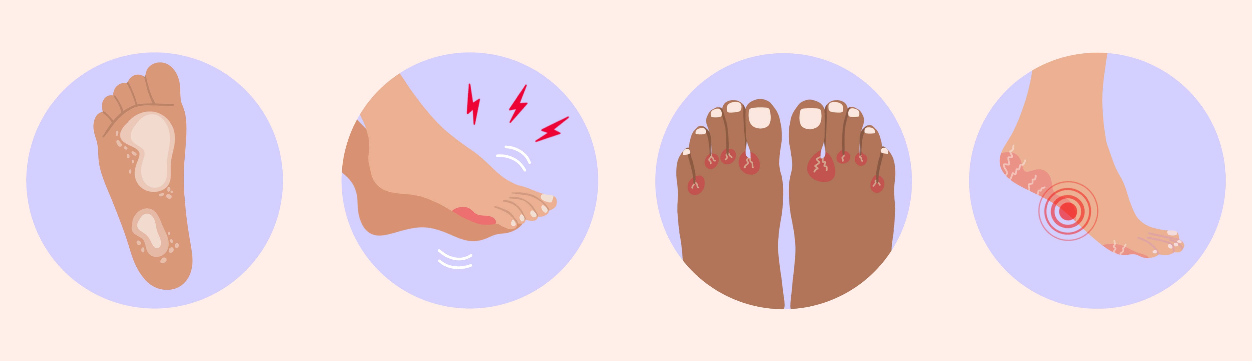 Fußpilz erkennen und behandeln | Shop Apotheke
